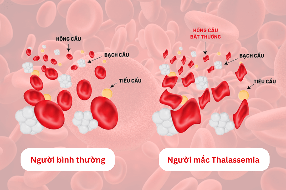Thalassemia có nguy hiểm không? Biểu hiện bệnh Thalassemia